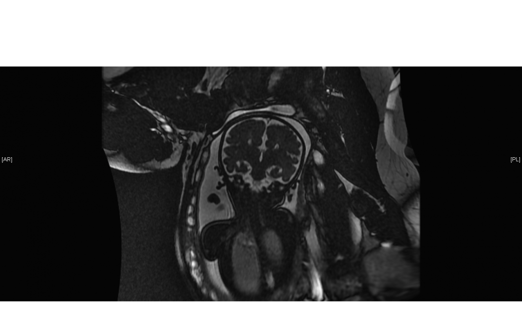 Agenesis of the Corpus Collosum (ACC) | Obstetrics & Gynecology