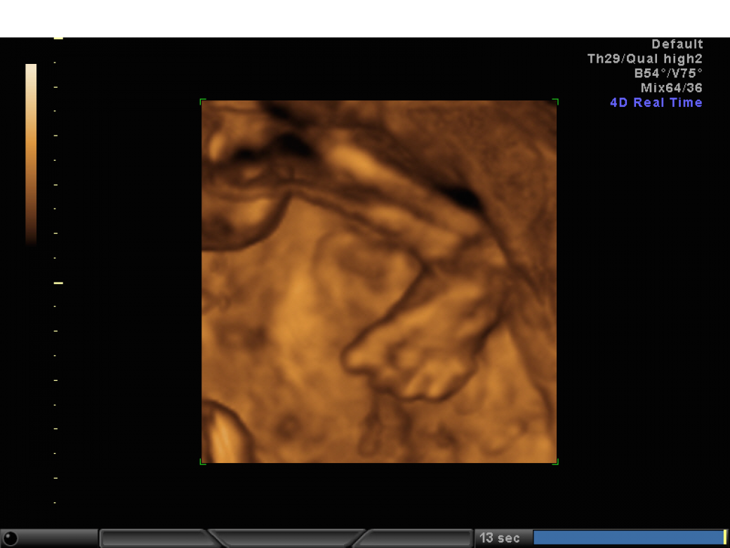 Clubfoot | Obstetrics & Gynecology