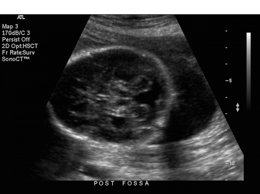 Dandy Walker Malformation and Variants | Obstetrics & Gynecology