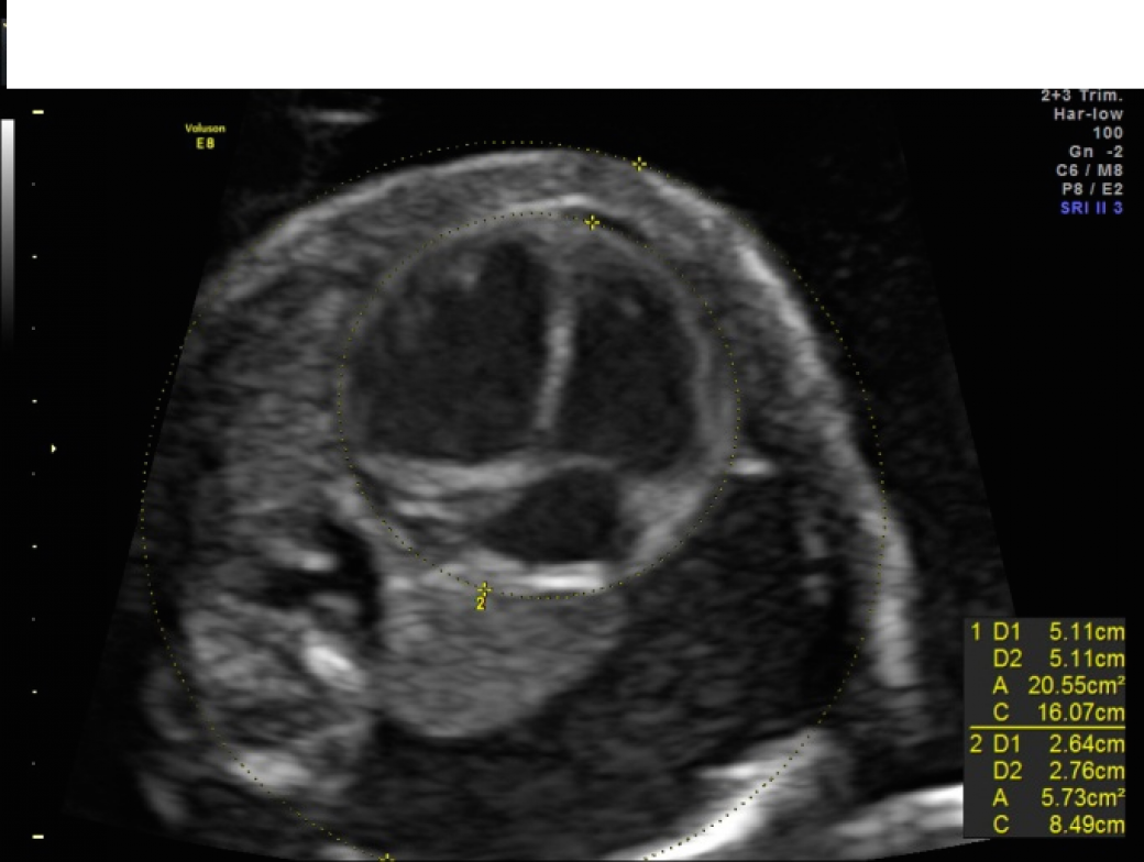 Hydrothorax | Obstetrics & Gynecology