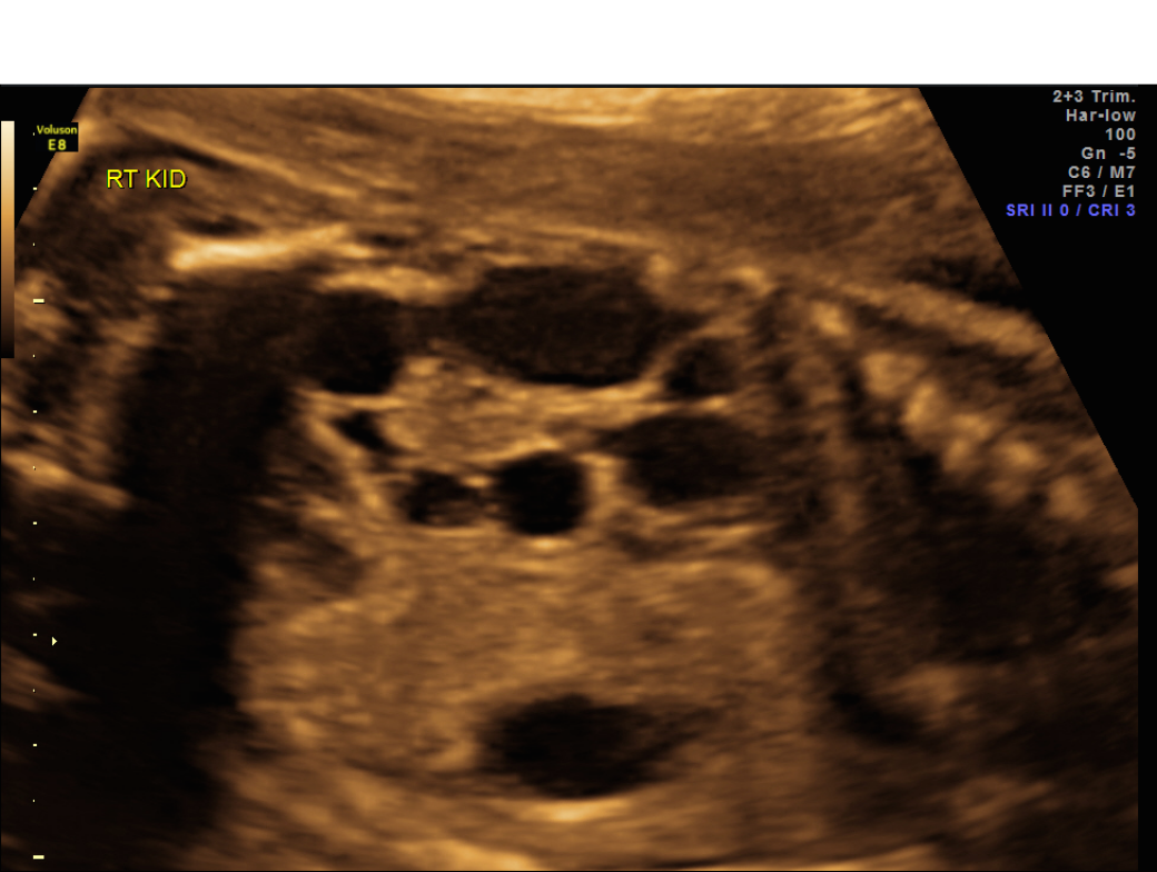Multicystic Dysplastic Kidney (MCDK) | Obstetrics & Gynecology