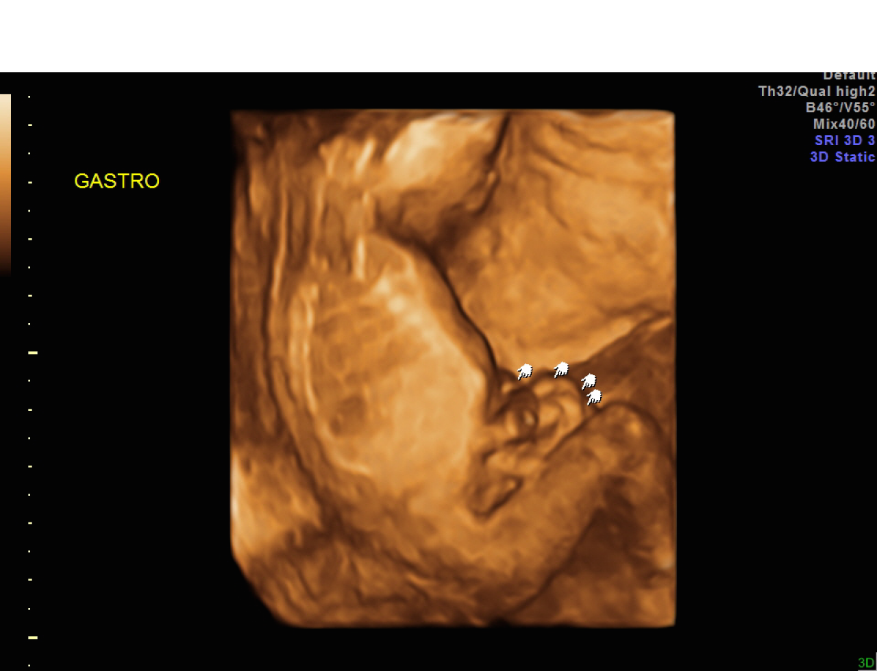 Gastroschisis | Obstetrics & Gynecology