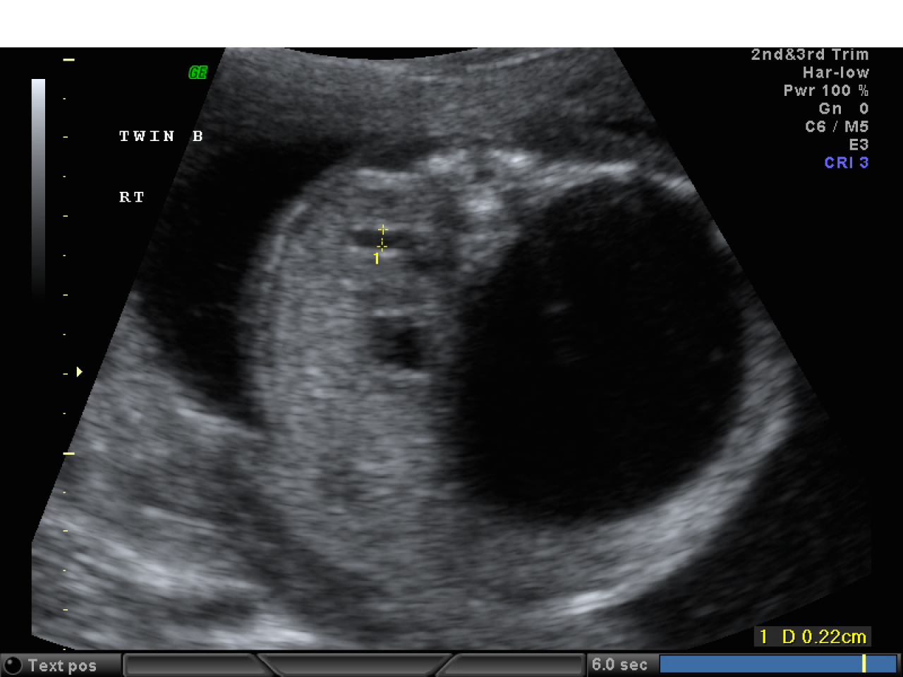Hydronephrosis | Obstetrics & Gynecology