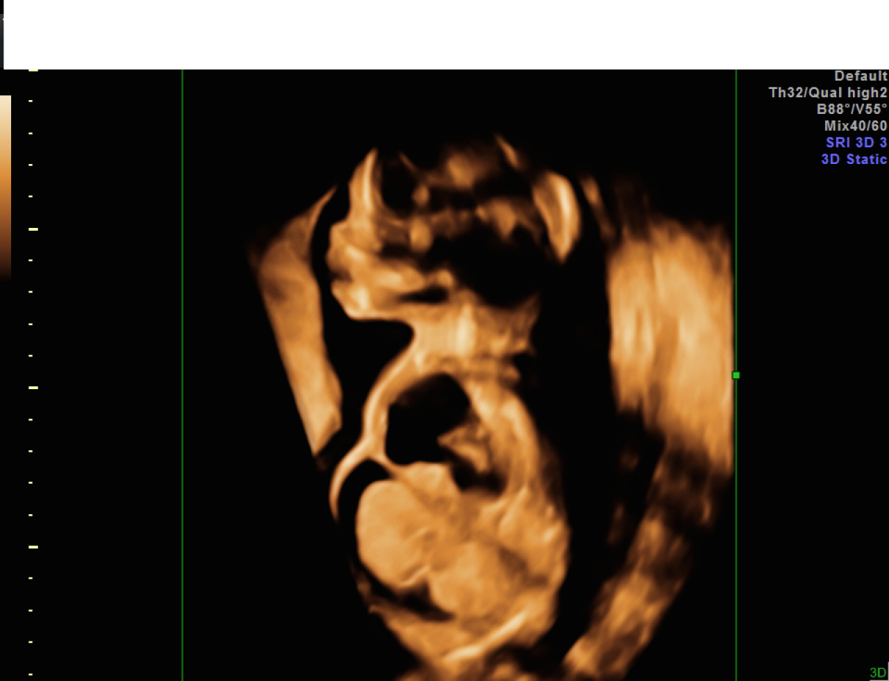 Hydrops | Obstetrics & Gynecology