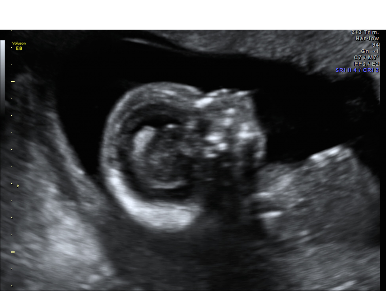 Micrognathia | Obstetrics & Gynecology