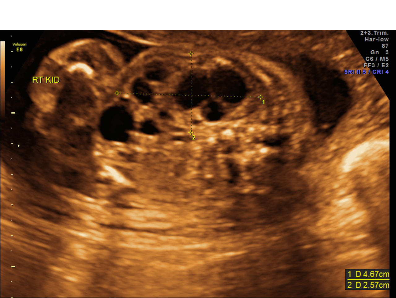 Multicystic Dysplastic Kidney (MCDK) | Obstetrics & Gynecology