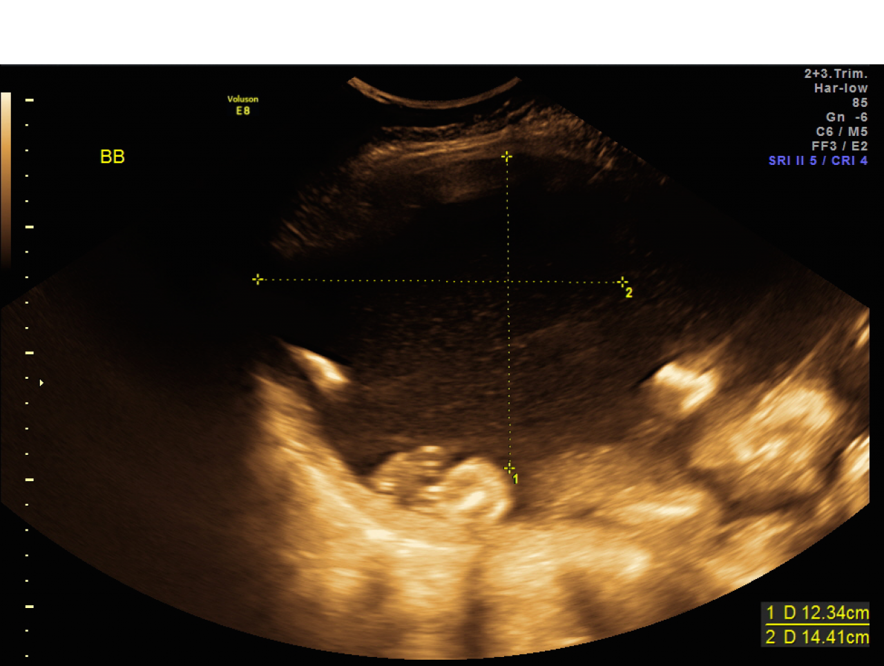 Twin-Twin Transfusion Syndrome (TTTS) | Obstetrics & Gynecology