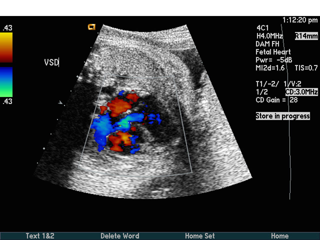 Ventricular Septal Defect (VSD) | Obstetrics & Gynecology