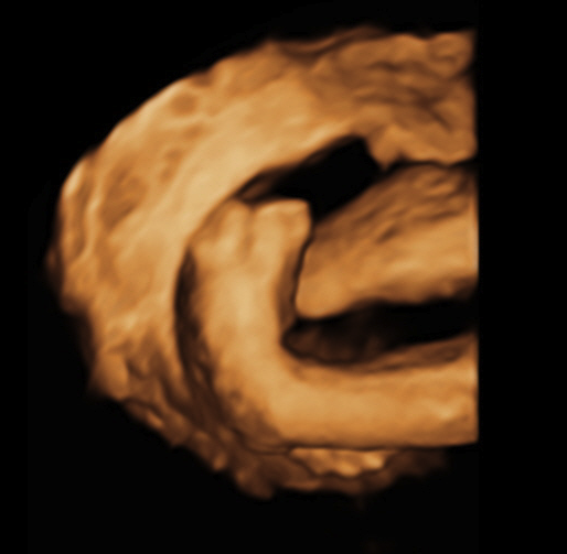 Clubfoot | Obstetrics & Gynecology