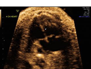 Ventricular Septal Defect (VSD) | Obstetrics & Gynecology