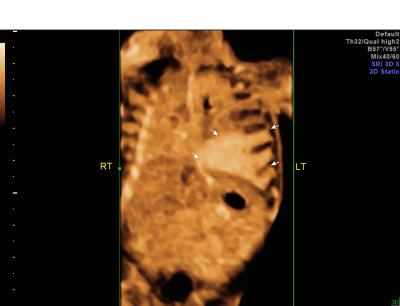 Bronchopulmonary Sequestration (BPS) | Obstetrics & Gynecology