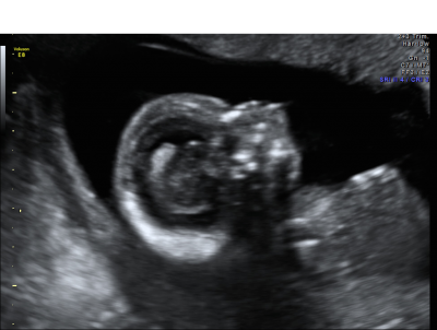 Micrognathia | Obstetrics & Gynecology