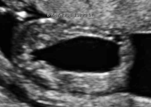 Lower Urinary Tract Obstruction (LUTO) | Obstetrics & Gynecology