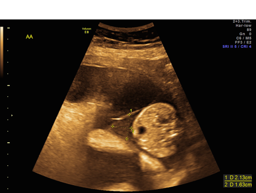Twin-Twin Transfusion Syndrome (TTTS) | Obstetrics & Gynecology