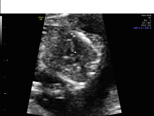 Ventricular Septal Defect (VSD) | Obstetrics & Gynecology