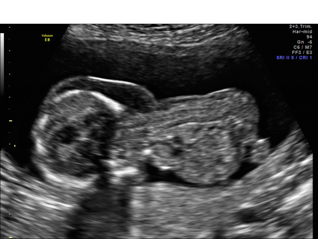 Cystic Hygroma | Obstetrics & Gynecology