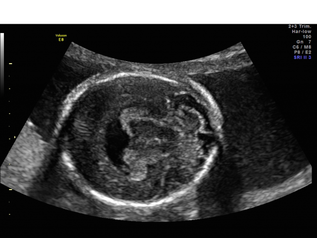 Holoprosencephaly | Obstetrics & Gynecology