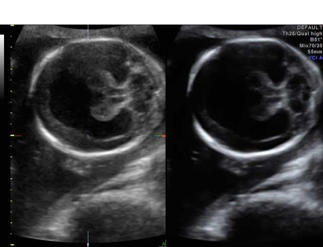 Holoprosencephaly | Obstetrics & Gynecology