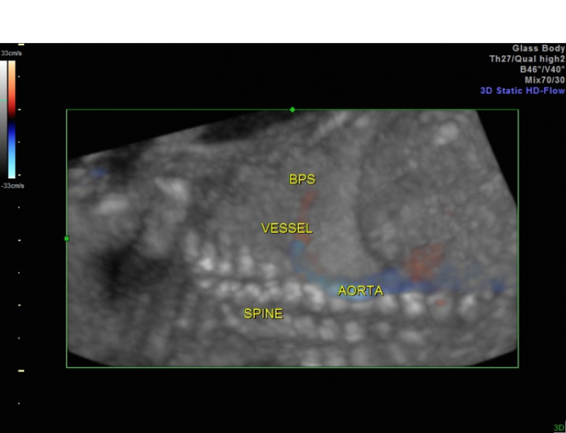 Bronchopulmonary Sequestration (BPS) | Obstetrics & Gynecology
