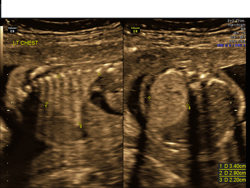 Congenital Cystic Adenomatoid Malformation (CCAM) | Obstetrics & Gynecology