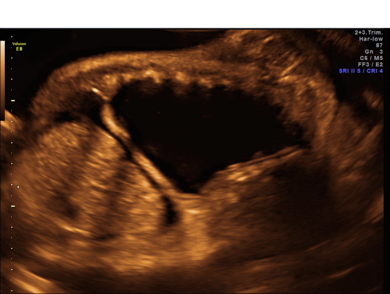 Hydrops | Obstetrics & Gynecology