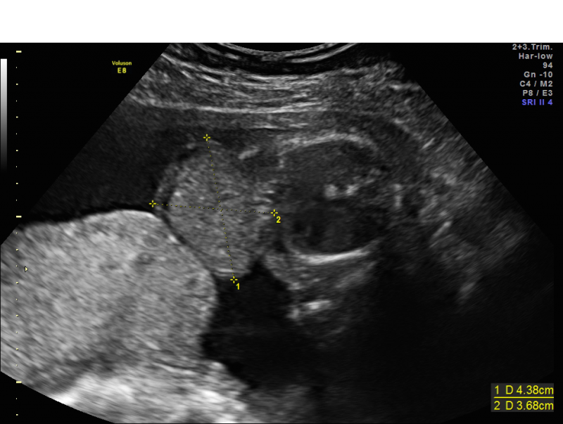 Omphalocele | Obstetrics & Gynecology